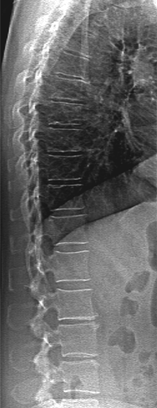 Horizon DXA System | Bone Densitometer | Hologic